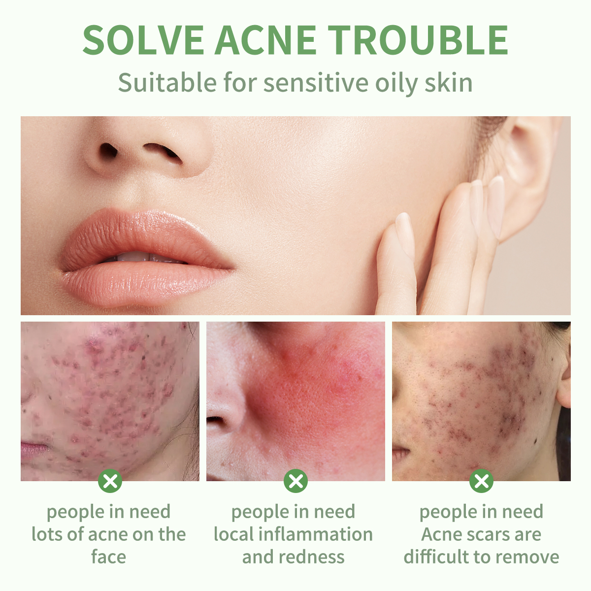 Salicylic Acid Acne Removal Gel 10g - PAPAFEEL